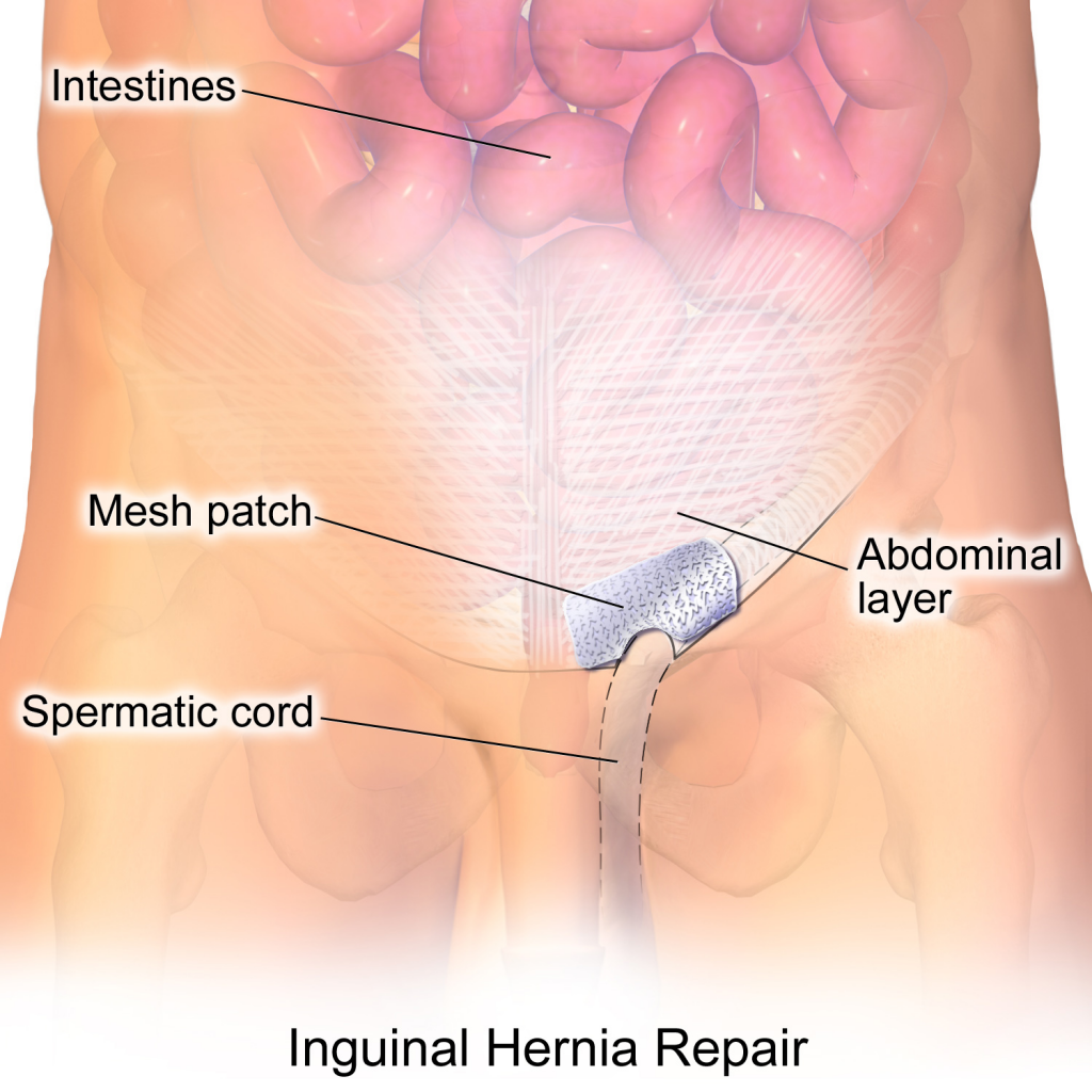 McCallister Law Group Provides Legal Advise Regarding Hernia Mesh McCallister Law Group Provides Legal Advise Regarding Hernia Mesh